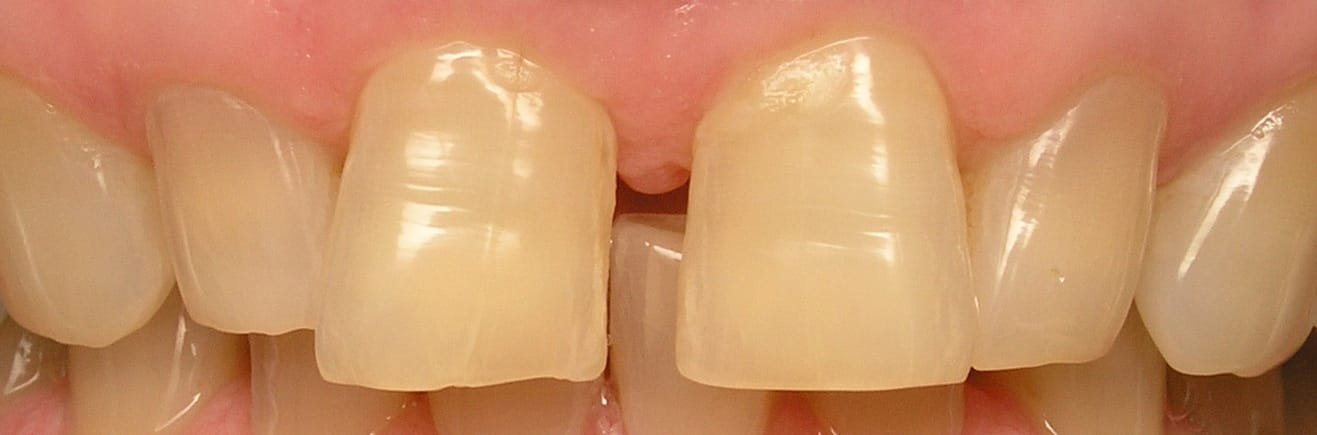 Gappy Teeth? Treatment Options - Platinum Dental, Inc.
